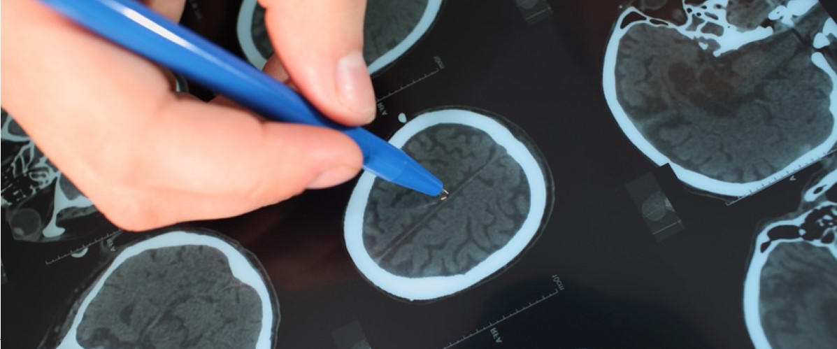 - Cure Brain Cancer Foundation